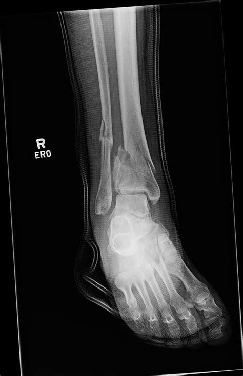 Orthodx Ankle Fracture Clinical Advisor