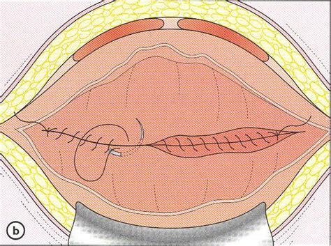 Hoping Not To Have A Csection But Good To Know If I Do Double Layer Cesarean Closures May Be