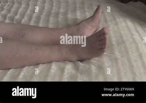 Varicose Veins And Thrombophlebitis In A Womans Legs Close Up Circulation Cardiovascular