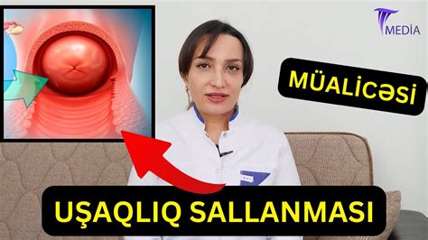 Uşaqlıq Sallanması MÜalİcƏsİ NƏdİr Youtube