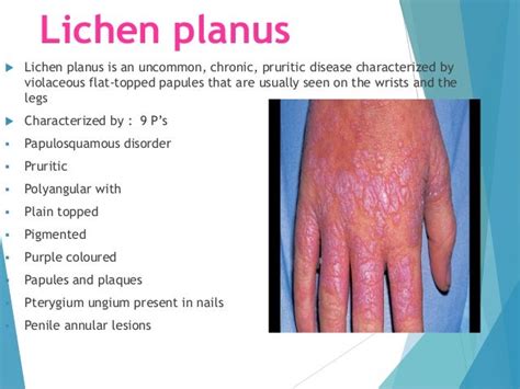 Lichen Planus