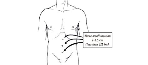 Laparoscopic Pyeloplasty For Pujo