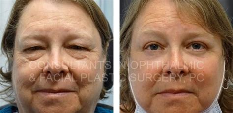 Blepharoplasty Both Upper Lids Ptosis Repair Both Upper Lids Excision