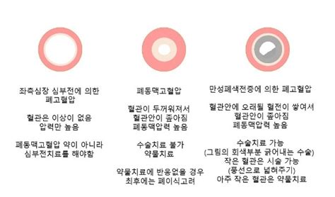 이해를 돕기위한 혈관 그림 폐동맥고혈압과 만성폐색전증에 의한 폐고혈압 네이버 블로그
