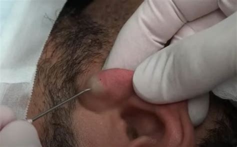 Ear Abscess Quick Pop R Pimplepopperdelight