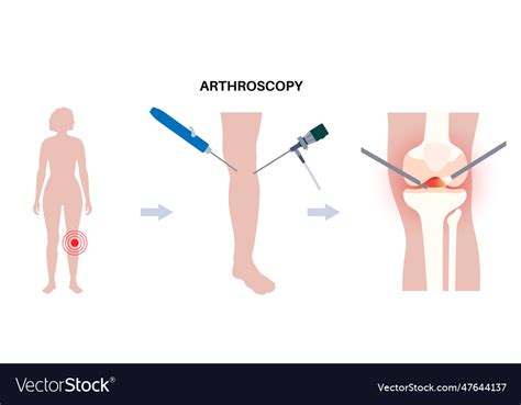 Knee Joint Arthroscopy Royalty Free Vector Image