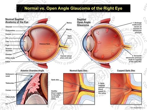 Closed Angle Glaucoma Vs Open Angle