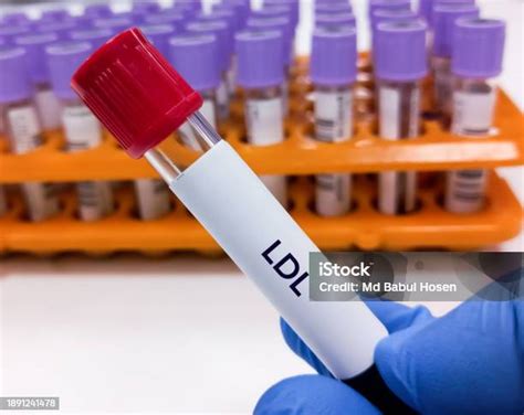 Ldl 검사용 혈액 샘플은 심장 질환 뇌졸중 심장 마비 및 심혈관 질환의 위험을 평가하는 데 도움이 됩니다