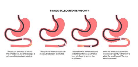 Premium Vector Single Balloon Enteroscopy Procedure Visualization Of