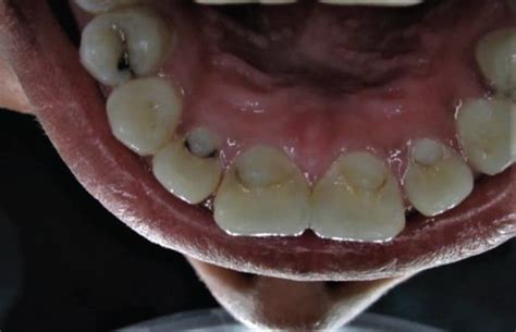 Case 4 Talon Cusps In All Upper Anterior Teeth Download Scientific