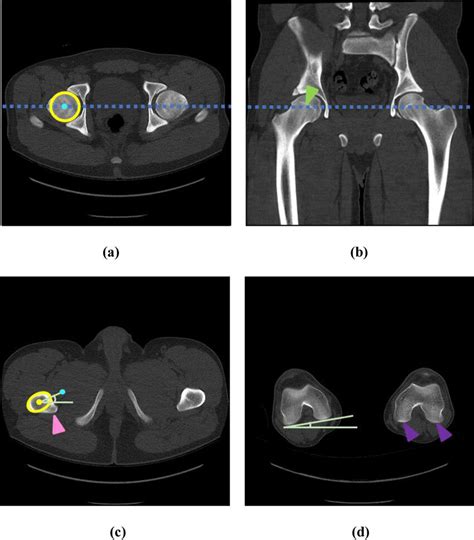 Femoral Version Measurement Via Murphys 2D Axial Slice Methodology In