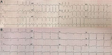 Incidental Discovery Of Dystrophic Myocardial Calcification Jacc Case Reports