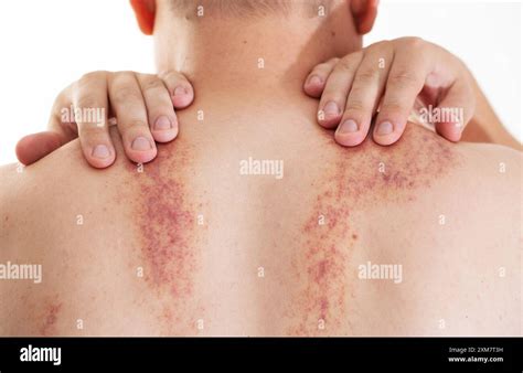 Marks On The Skin Of A Mans Back After A Massage Concept Of Improper