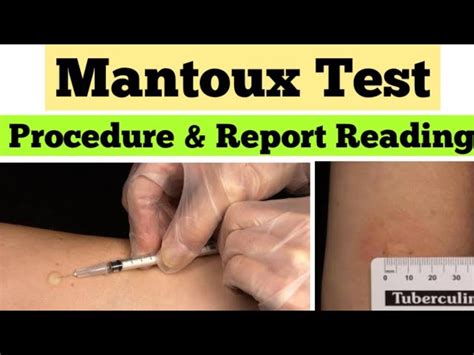 Mantoux Test Principle Procedure Interpretation And 60 Off
