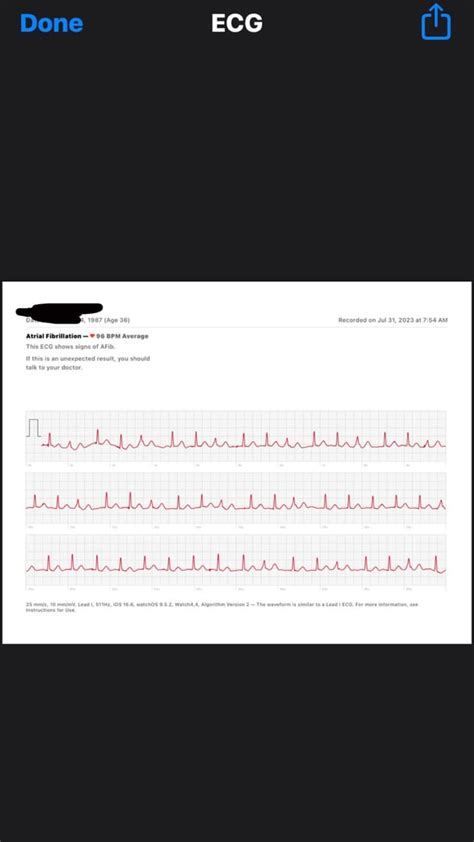 My Echocardiogram Results R Pvcs