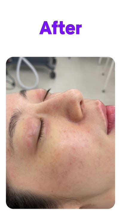 트라이엄 레이저 시술 후기 공개 단 40분만에 피부고민 해결 Youtube