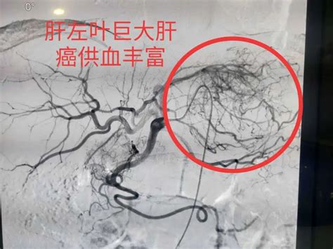 介入治疗丨肿瘤是如何“饿死”的澎湃号·政务澎湃新闻 The Paper