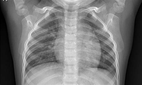 X Ray Image Classification The Easy Way Artofit X Ray Image Classification The Easy Way Artofit