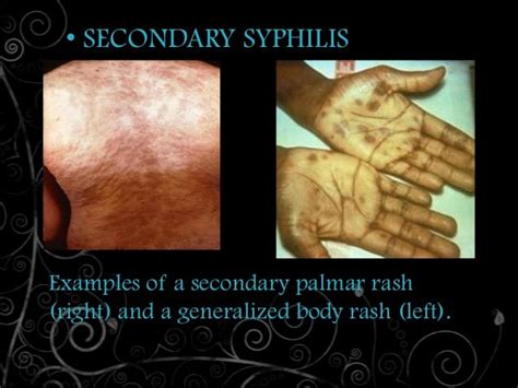 Syphilis Disease