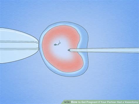 3 Ways To Get Pregnant If Your Partner Had A Vasectomy Wikihow