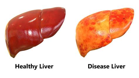 Foods To Eat And Avoid In A Liver Cirrhosis Patients Diet