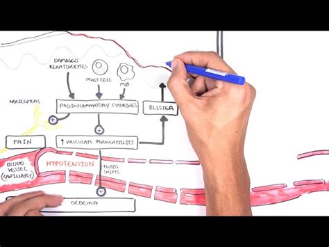 Burns Pathophysiology 2025