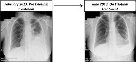 Imaging Showing Treatment Response To Erlotinib Download Scientific