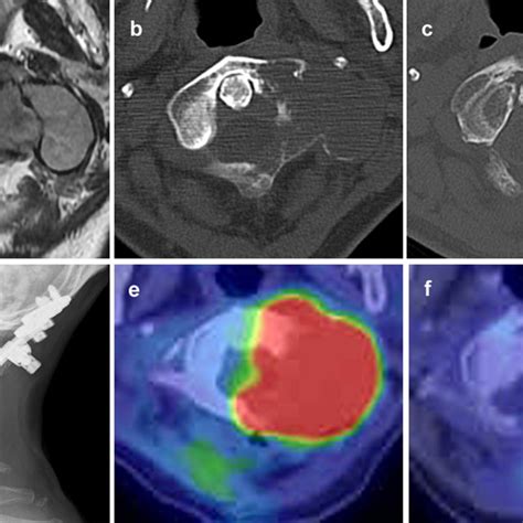 A 73 Year Old Woman With Spindle Cell Sarcoma Of High Grade Malignancy Download Scientific