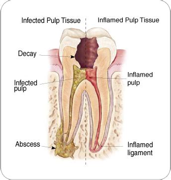 Endodontic Specialists P A Endodontics Procedures Endodontic Treatment