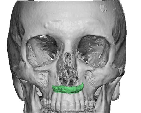 Medpor Cheek Implants 3d Ct Scan Front View Dr Barry Eppley Explore