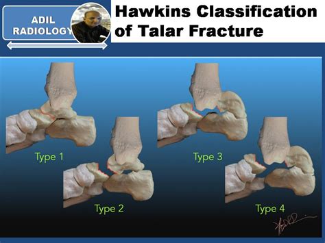Hawkins Classification Of Talar Radiology Classroom