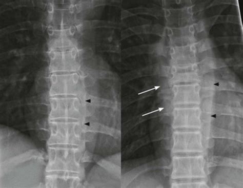 501 T Spine And L Spine Pce Flashcards Quizlet