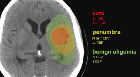 ischemic penumbra stroke manual