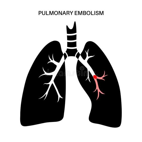 Pulmonary Embolism Disease Stock Vector Illustration Of Breath 255787101