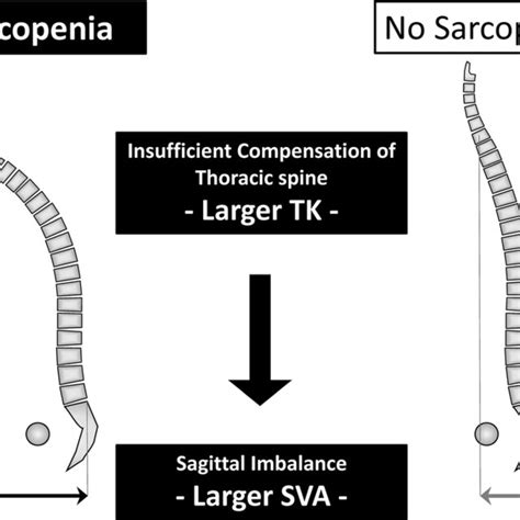 Diagnostic Algorithm Of Sarcopenia Asian Working Group For Sarcopenia