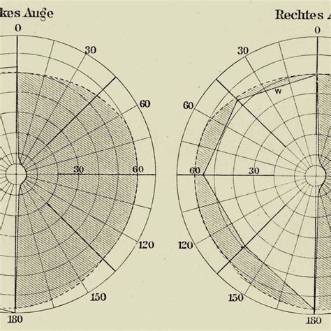 Left Hemianopia With Macular Sparing A A 68 Year Old Man With Left