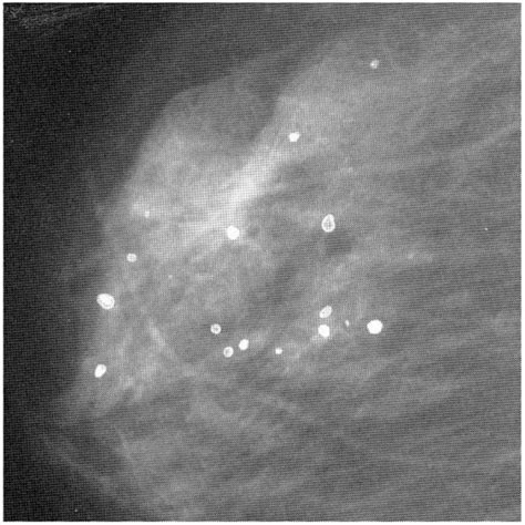 A Mammogram Of Female Breast Revealing Micro Calcifications White