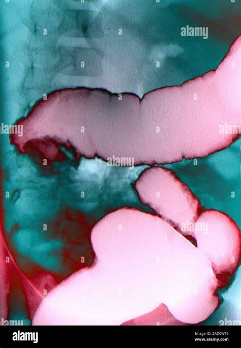 Intussusception Of The Intestines Coloured Barium X Ray Of A Section Through The Abdomen Of A