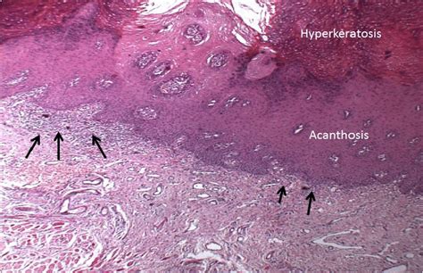 Figure5 Showing Stratified Squamous Epithelium With Excessive