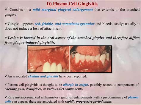Gingival Enlargment And Its Treatment Pptx