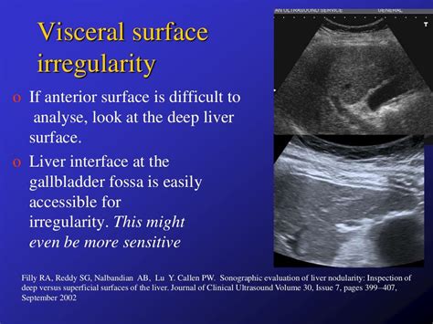 Ultrasound In Portal Hypertension