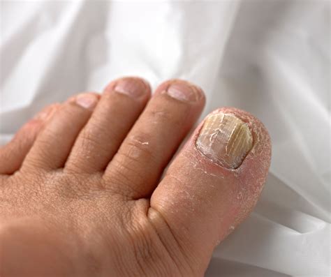 Nail Fungus Causes Symptoms Treatments And Prevention 60 Off