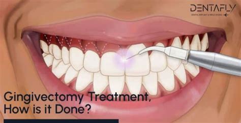 Gingivectomy A Complete Guide About Gingiva 2023