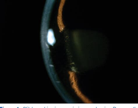 Figure 1 From Bilateral Acute Retinal Necrosis Associated With Bilateral Uveal Effusion In An