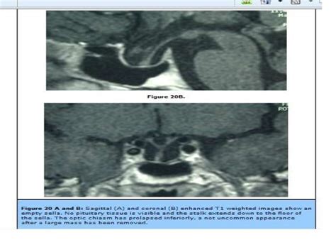 Presentation1pptx Sellar And Para Sellar Masses