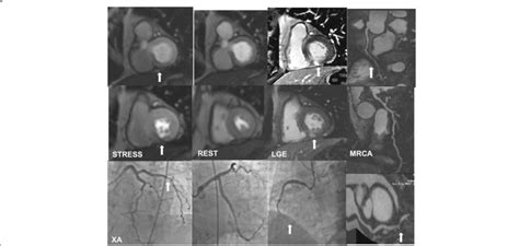 One Case Illustrating Myocardial Perfusion Imaging MPI Late Download Scientific Diagram