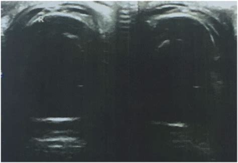 B Scan Ultrasound Performed At 1 Month Postoperatively Scans Indicate