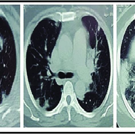 Chest Radiograph Showing Patchy Opacities In The Bilateral Lower Lung