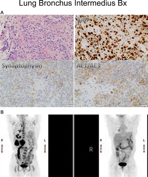 Genomic Profiling Of Solid Tumors Harboring Brd4 Nut And Response To