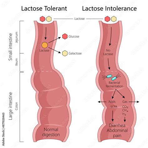 Poster Lactose Tolerance And Intolerance Normal Digestion With Lactase And Symptoms From